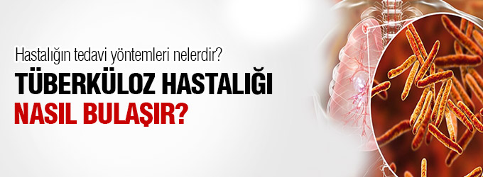 Tüberküloz hastalığı nasıl bulaşır? Tedavisi nedir?